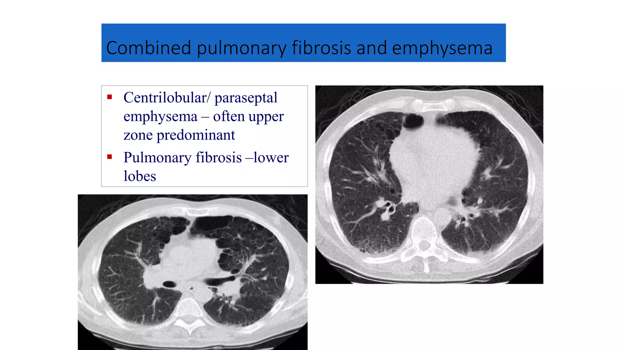 RADIOLOGY OF ILD.pptx