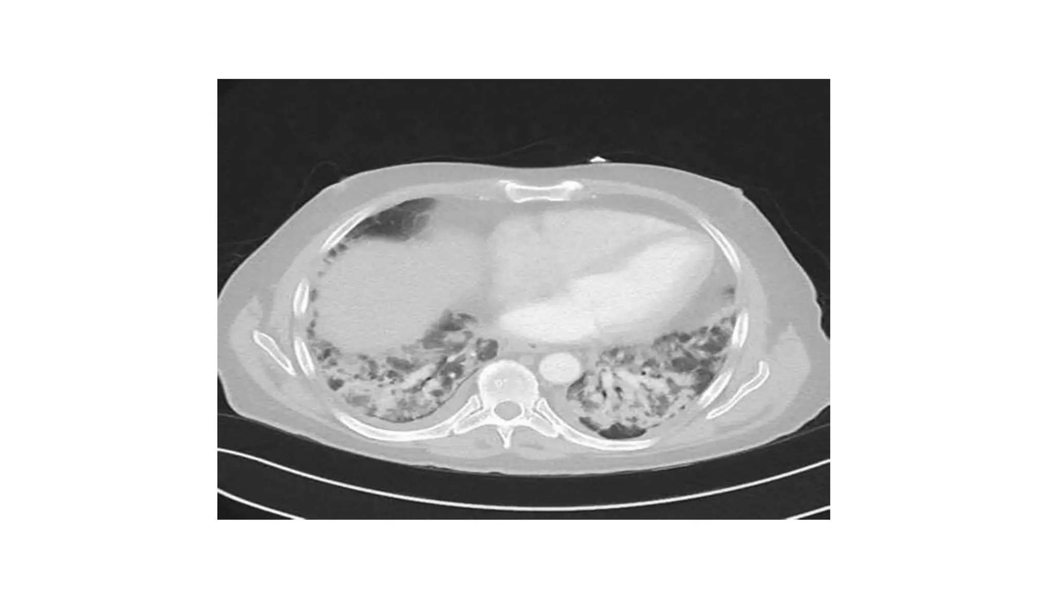 RADIOLOGY OF ILD.pptx