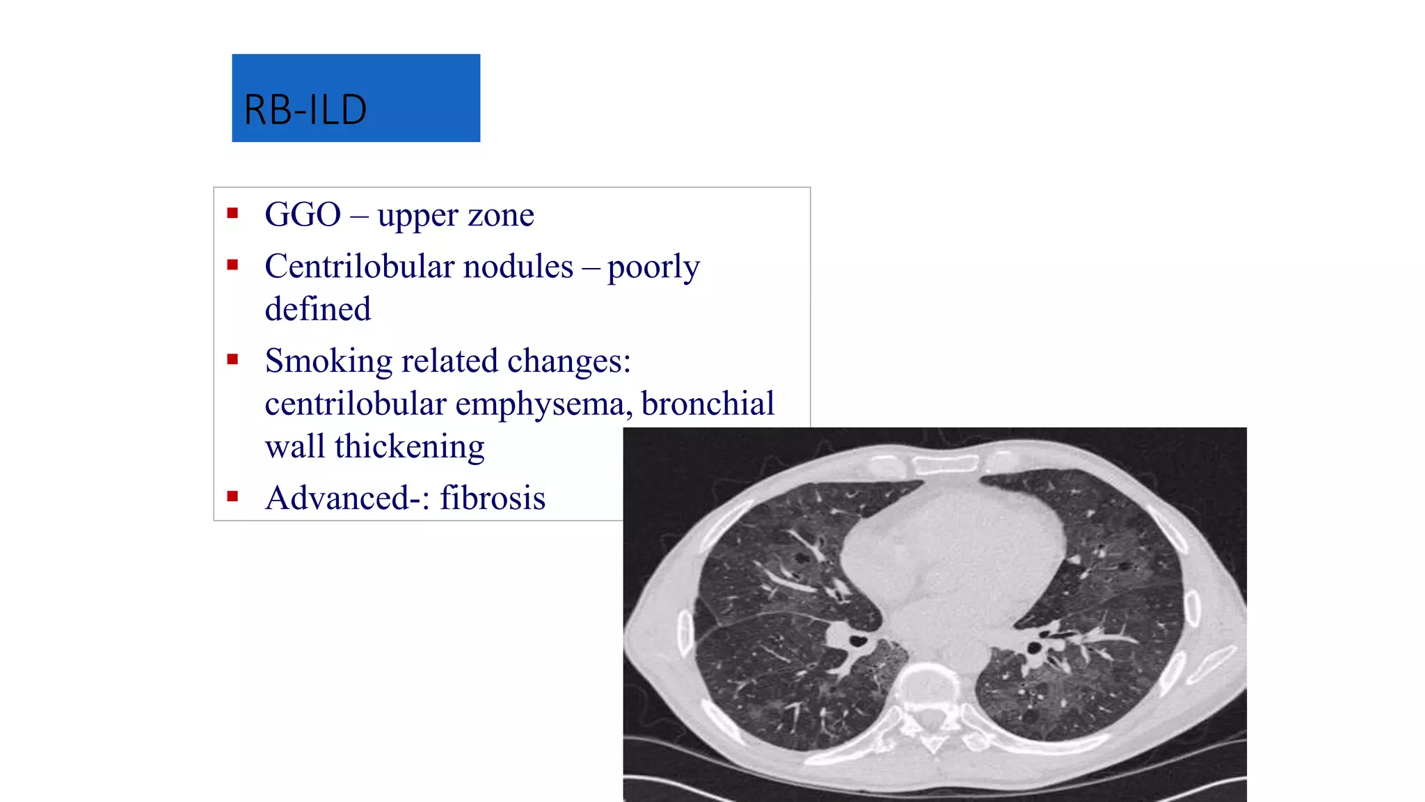 RADIOLOGY OF ILD.pptx