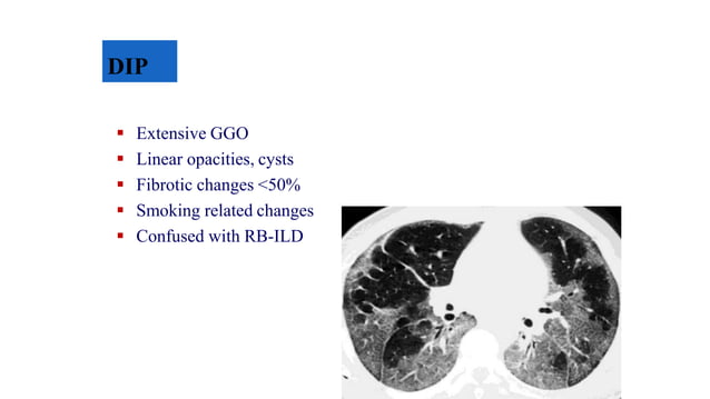 RADIOLOGY OF ILD.pptx