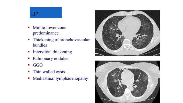 RADIOLOGY OF ILD.pptx