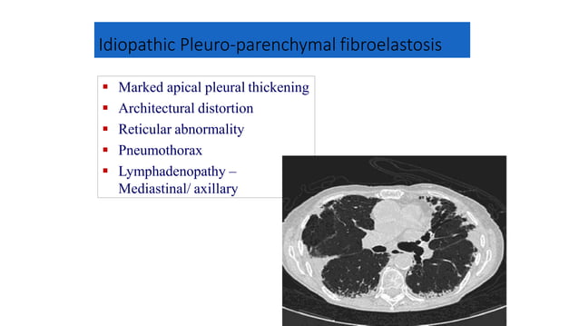 RADIOLOGY OF ILD.pptx