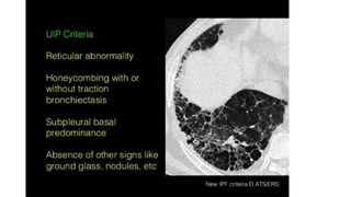 RADIOLOGY OF ILD.pptx