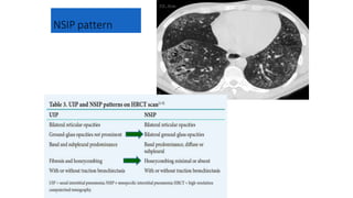RADIOLOGY OF ILD.pptx