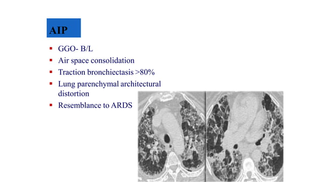 RADIOLOGY OF ILD.pptx