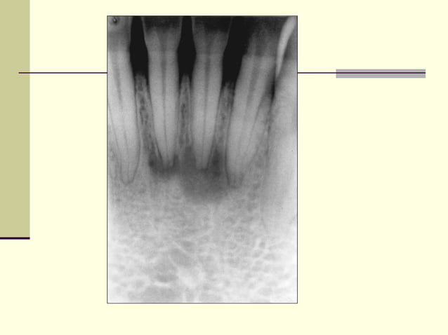 Radiology of inflammatory lesions of the jaws | PPT | Bone and Joint ...