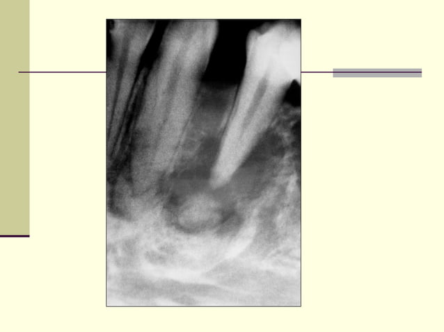 Radiology of inflammatory lesions of the jaws | PPT | Bone and Joint ...