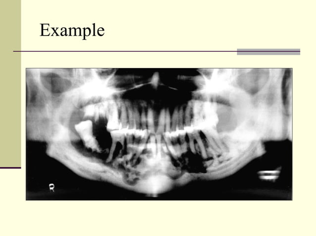 Radiology of inflammatory lesions of the jaws | PPT | Bone and Joint ...