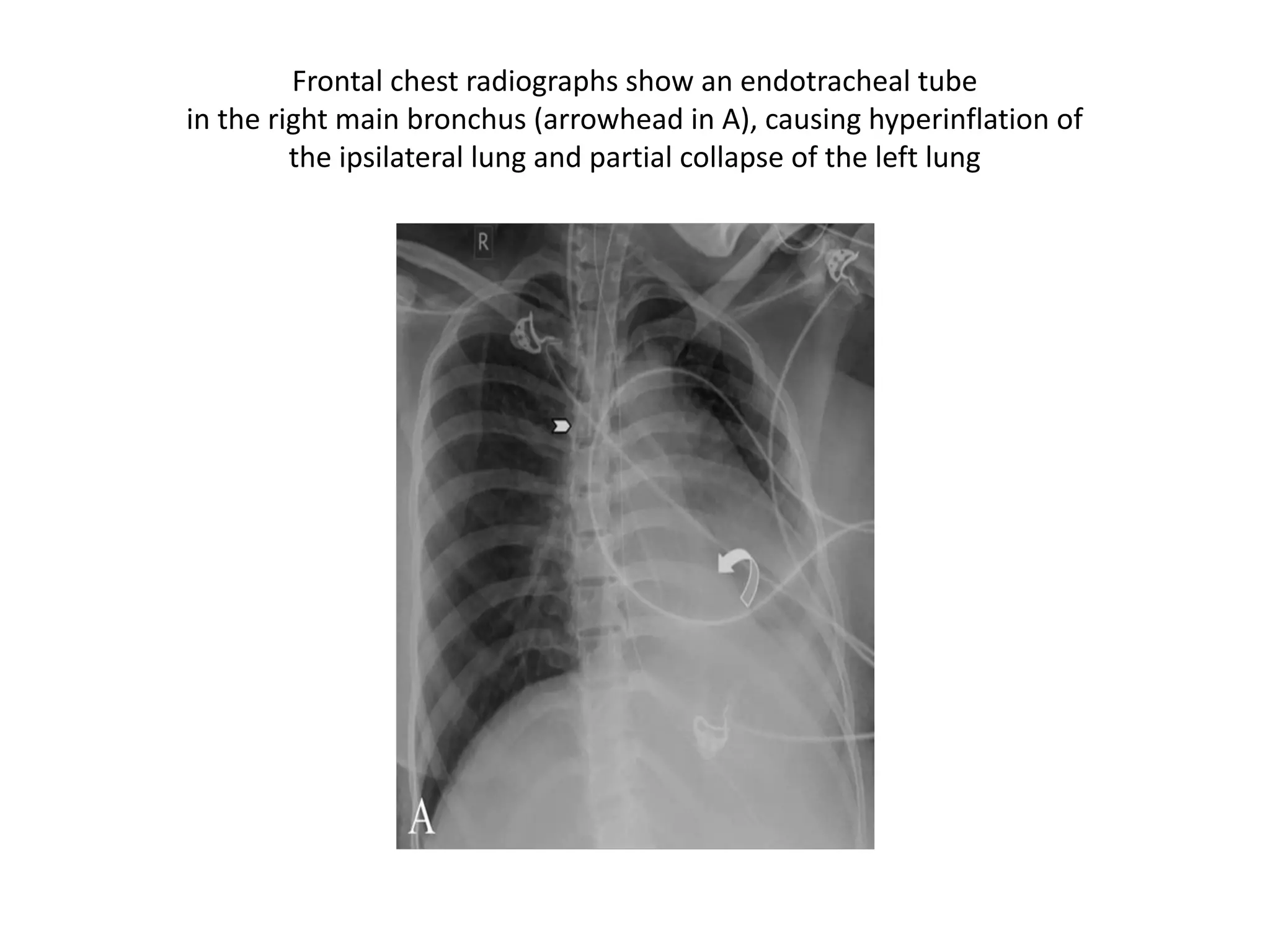 RADIOLOGY OF LINES AND TUBES IN INTENSIVE CARE SEMINAR.pdf