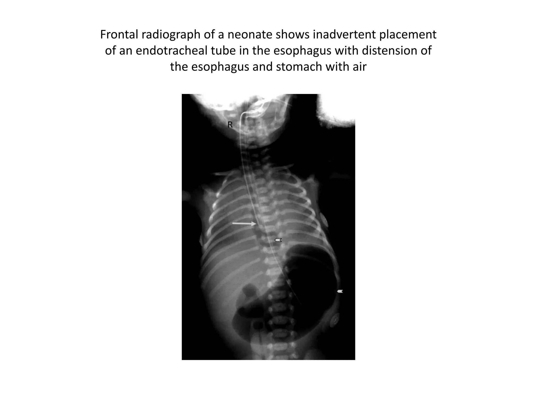 RADIOLOGY OF LINES AND TUBES IN INTENSIVE CARE SEMINAR.pdf