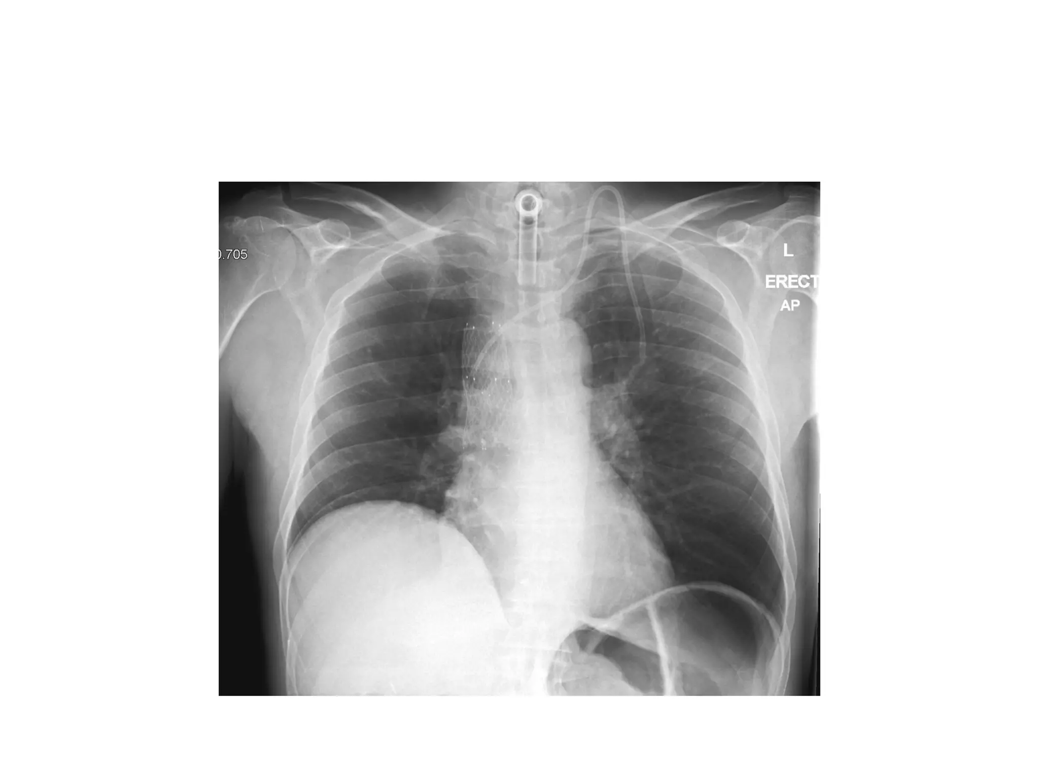 RADIOLOGY OF LINES AND TUBES IN INTENSIVE CARE SEMINAR.pdf