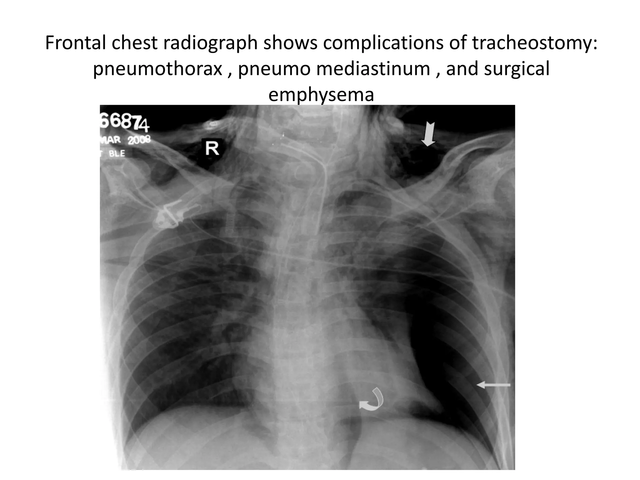 RADIOLOGY OF LINES AND TUBES IN INTENSIVE CARE SEMINAR.pdf