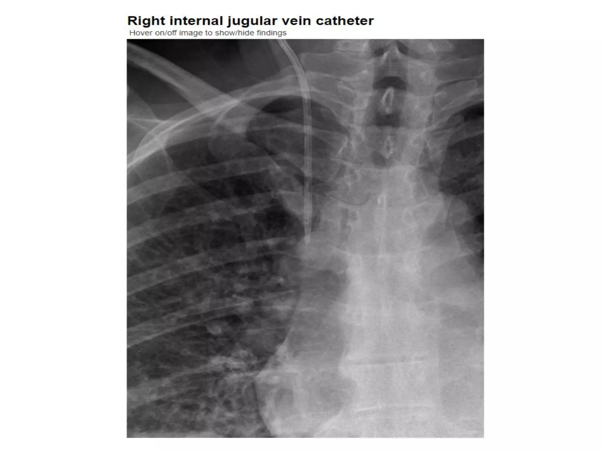 RADIOLOGY OF LINES AND TUBES IN INTENSIVE CARE SEMINAR.pdf