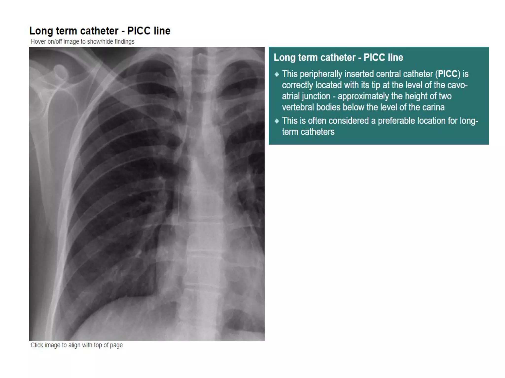 RADIOLOGY OF LINES AND TUBES IN INTENSIVE CARE SEMINAR.pdf