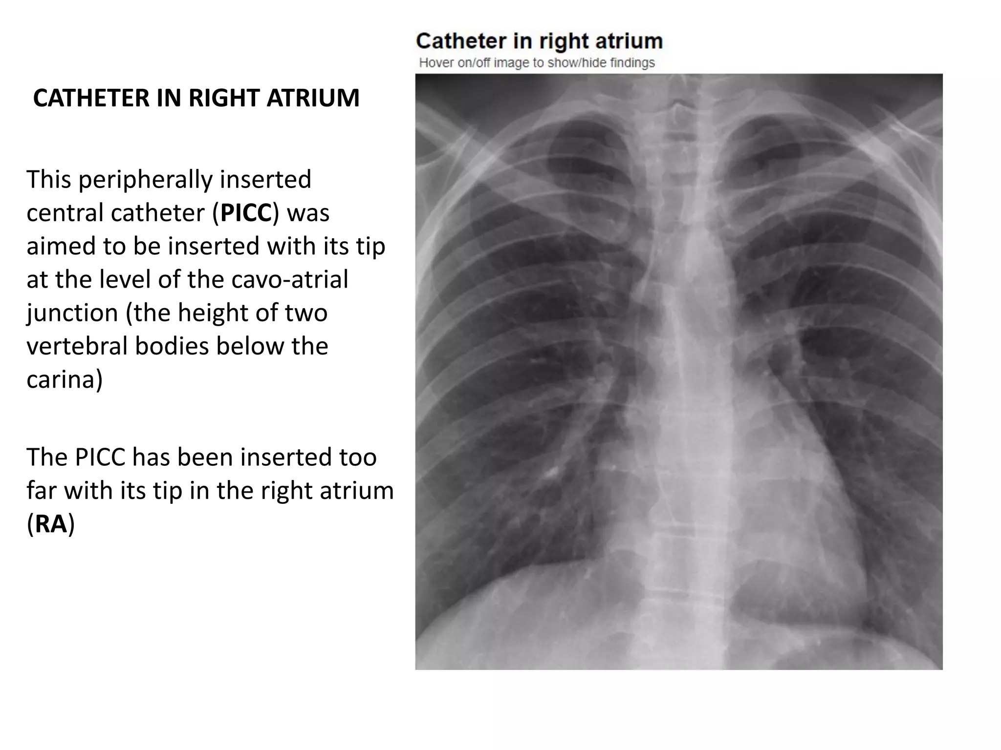 RADIOLOGY OF LINES AND TUBES IN INTENSIVE CARE SEMINAR.pdf