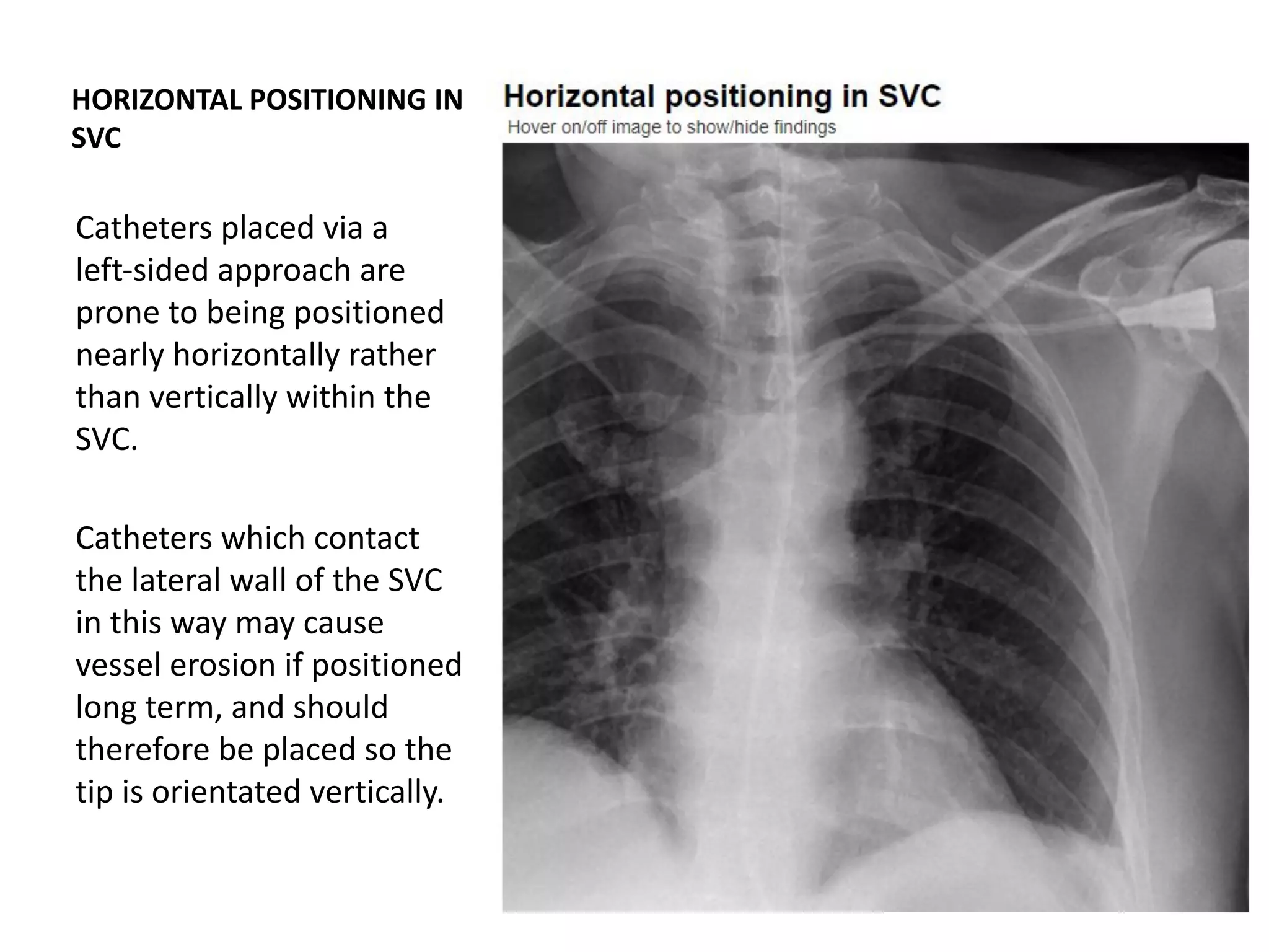 RADIOLOGY OF LINES AND TUBES IN INTENSIVE CARE SEMINAR.pdf