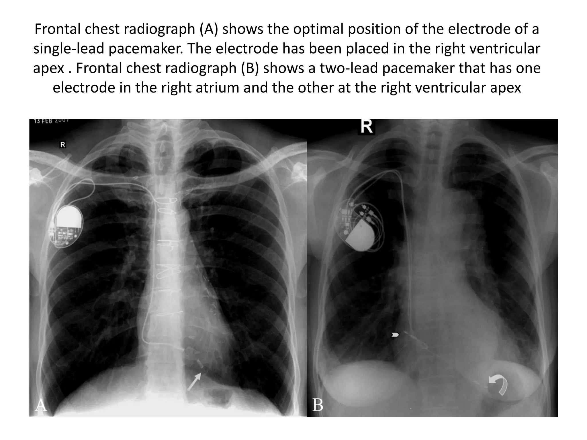 RADIOLOGY OF LINES AND TUBES IN INTENSIVE CARE SEMINAR.pdf