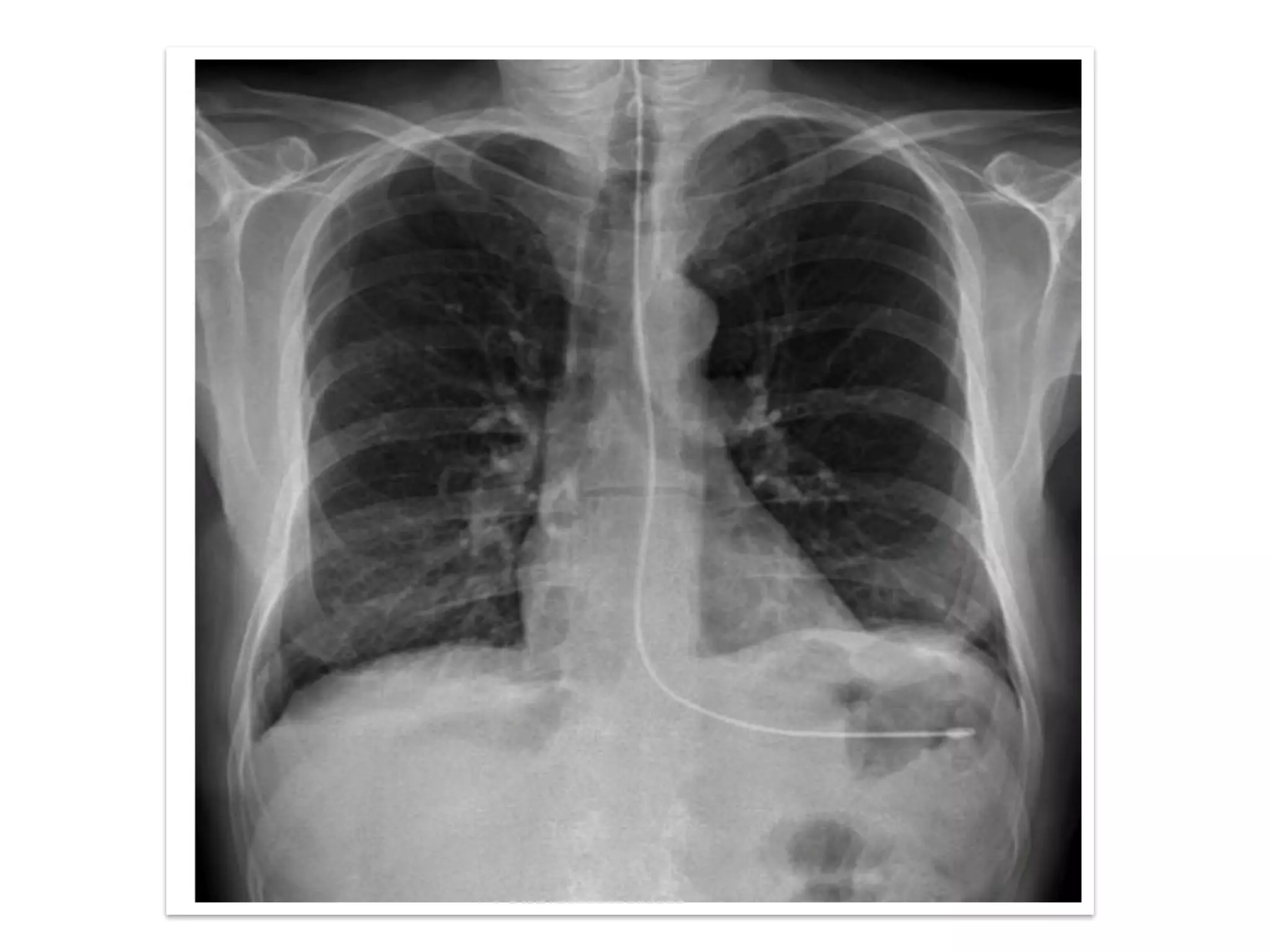 RADIOLOGY OF LINES AND TUBES IN INTENSIVE CARE SEMINAR.pdf