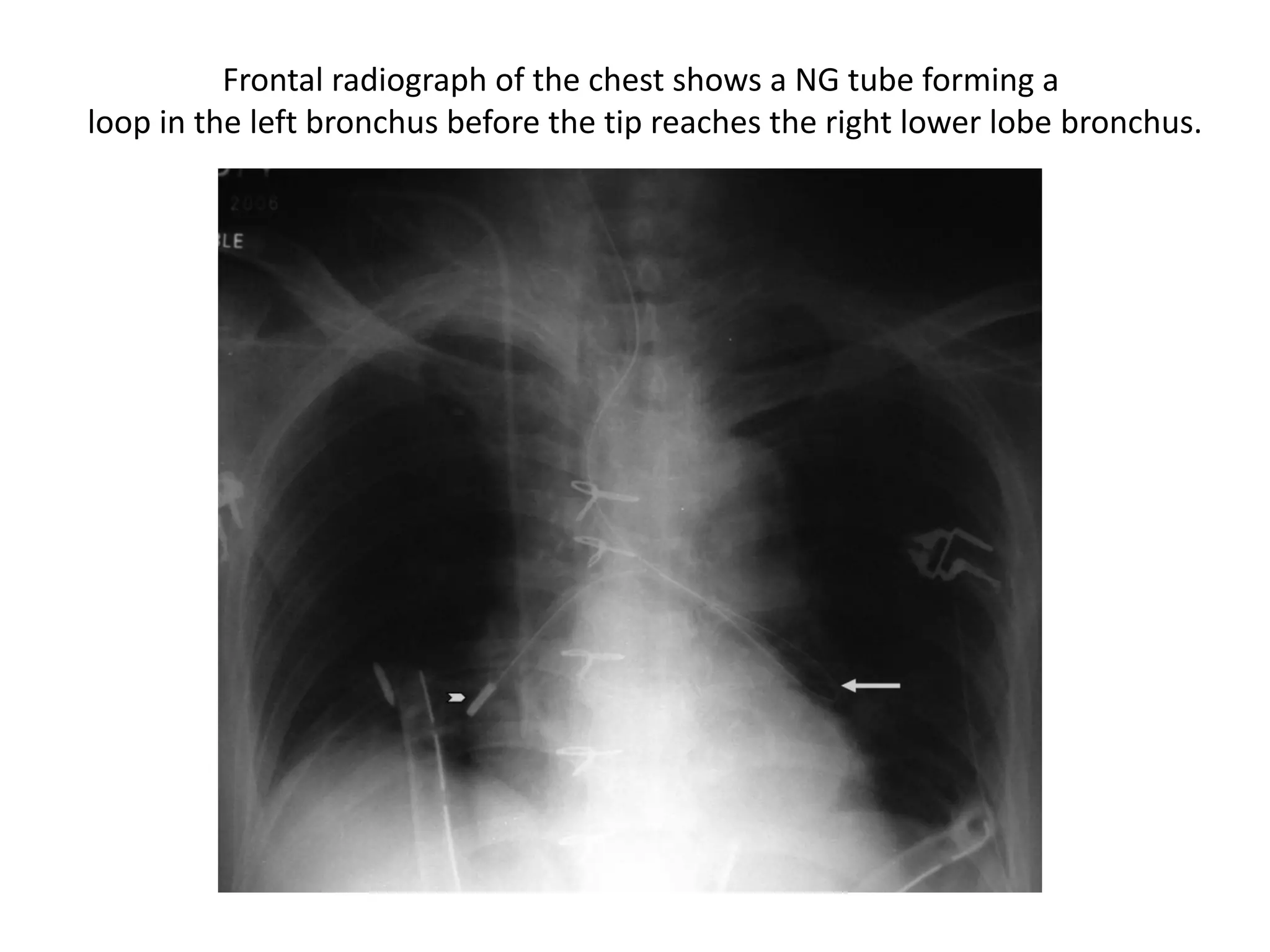 RADIOLOGY OF LINES AND TUBES IN INTENSIVE CARE SEMINAR.pdf