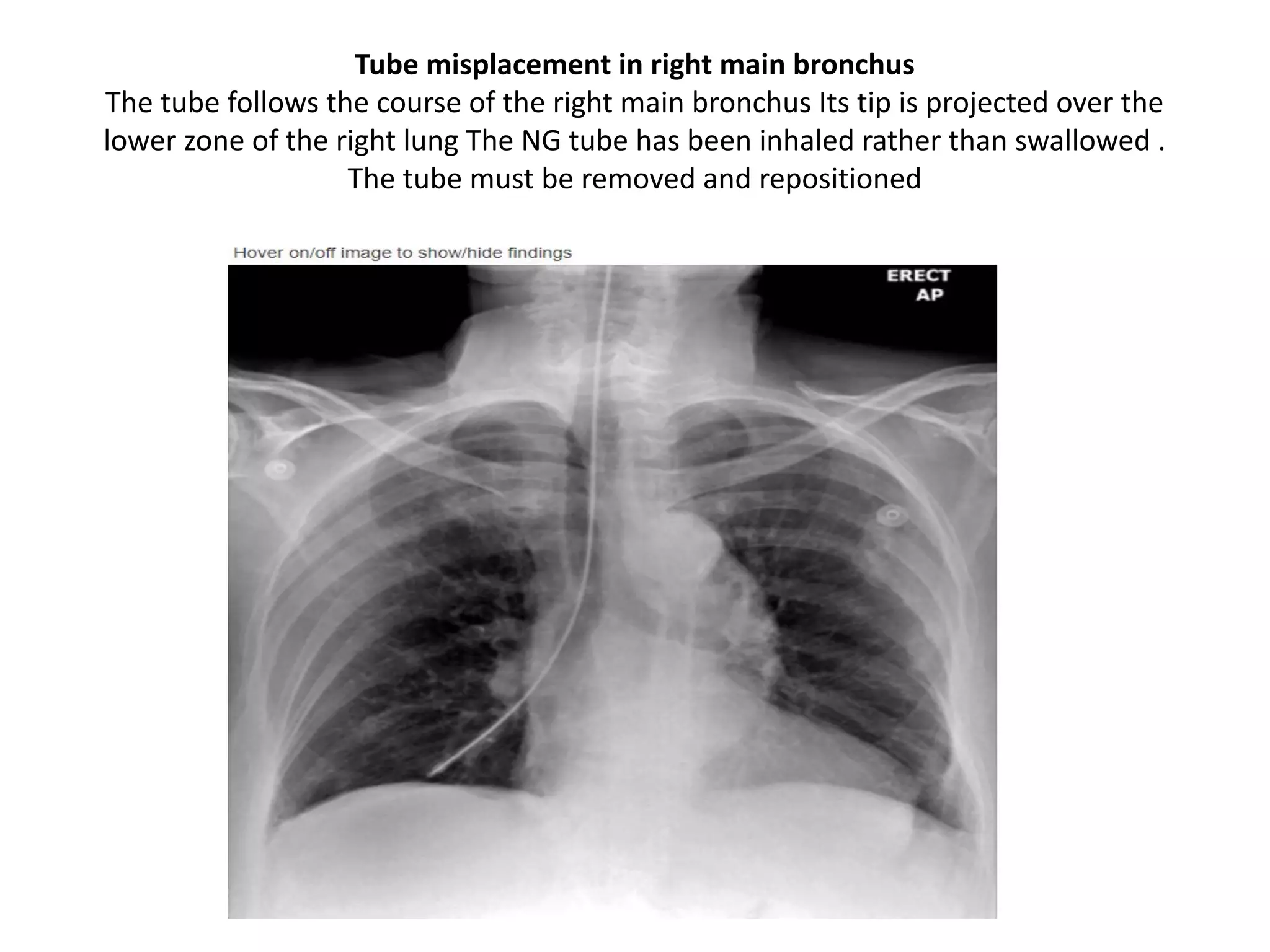 RADIOLOGY OF LINES AND TUBES IN INTENSIVE CARE SEMINAR.pdf