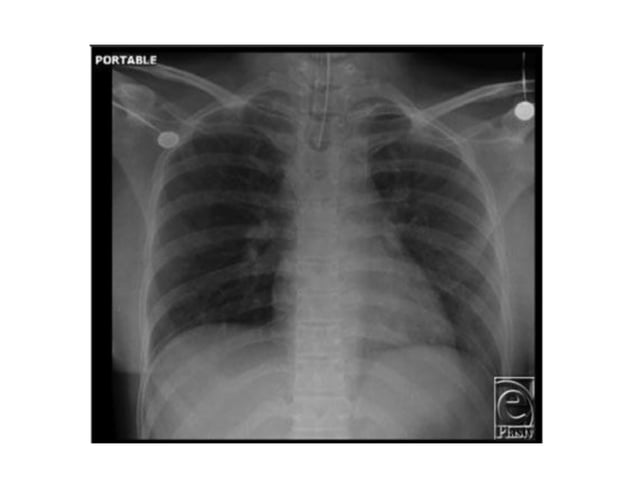 RADIOLOGY OF LINES AND TUBES IN INTENSIVE CARE SEMINAR.pdf