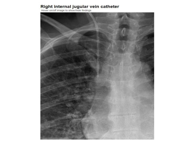 RADIOLOGY OF LINES AND TUBES IN INTENSIVE CARE SEMINAR.pdf