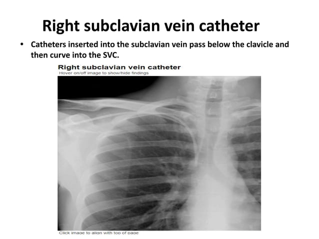 RADIOLOGY OF LINES AND TUBES IN INTENSIVE CARE SEMINAR.pdf