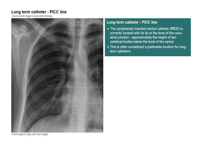 RADIOLOGY OF LINES AND TUBES IN INTENSIVE CARE SEMINAR.pdf