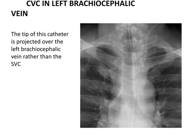 RADIOLOGY OF LINES AND TUBES IN INTENSIVE CARE SEMINAR.pdf
