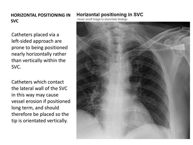 RADIOLOGY OF LINES AND TUBES IN INTENSIVE CARE SEMINAR.pdf