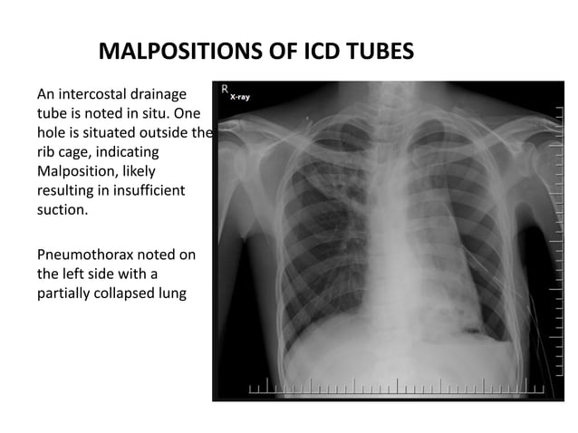 RADIOLOGY OF LINES AND TUBES IN INTENSIVE CARE SEMINAR.pdf