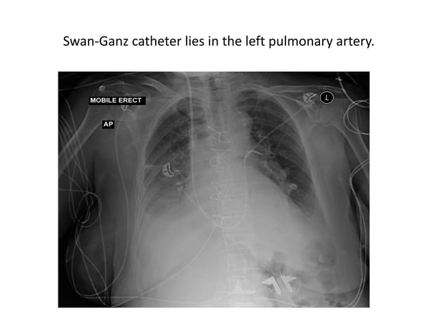 RADIOLOGY OF LINES AND TUBES IN INTENSIVE CARE SEMINAR.pdf