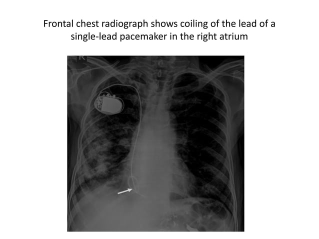 RADIOLOGY OF LINES AND TUBES IN INTENSIVE CARE SEMINAR.pdf