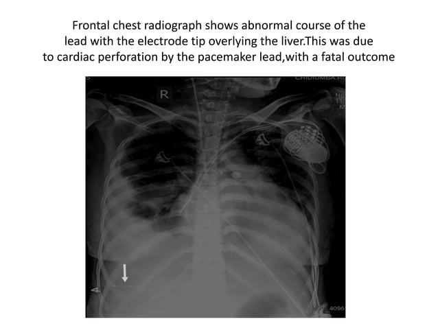RADIOLOGY OF LINES AND TUBES IN INTENSIVE CARE SEMINAR.pdf