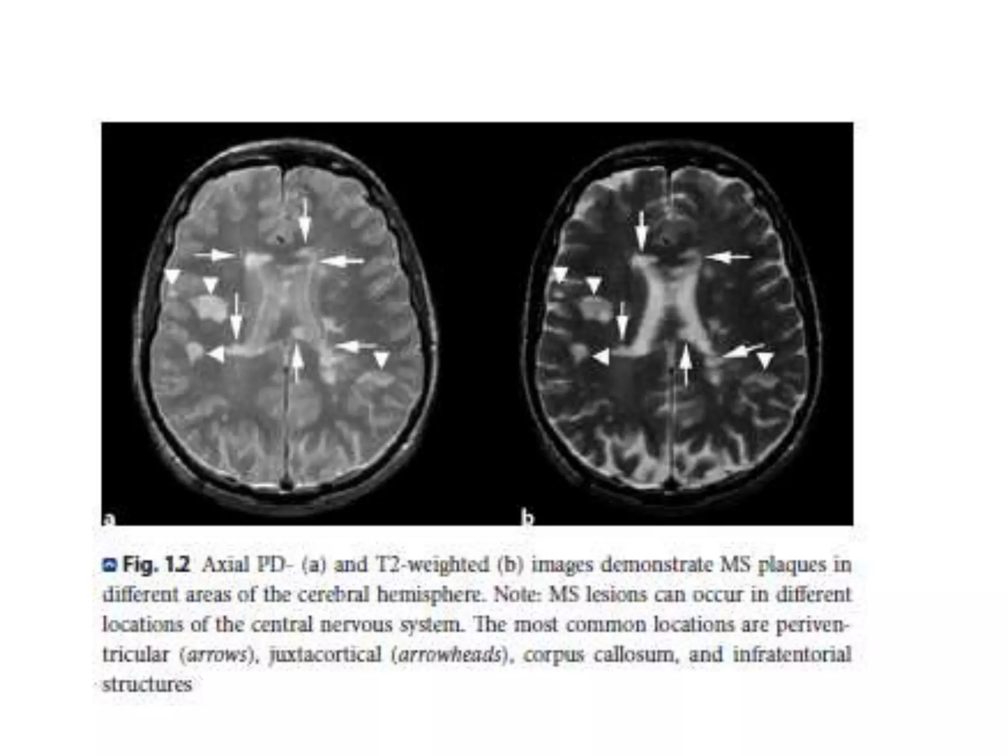 Radiology of MULTIPLE SCLEROSIS | PPTX