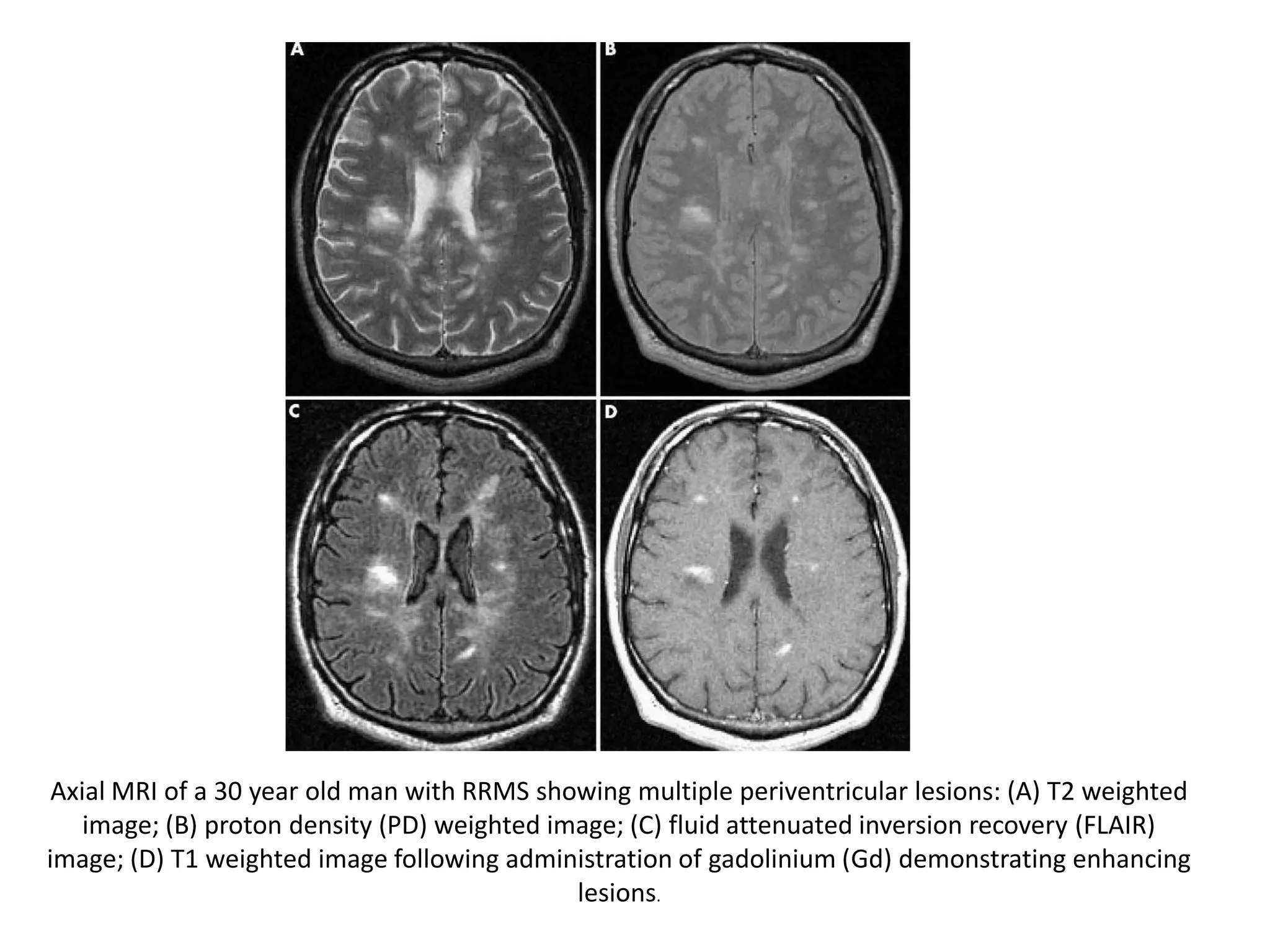 Radiology of MULTIPLE SCLEROSIS | PPTX