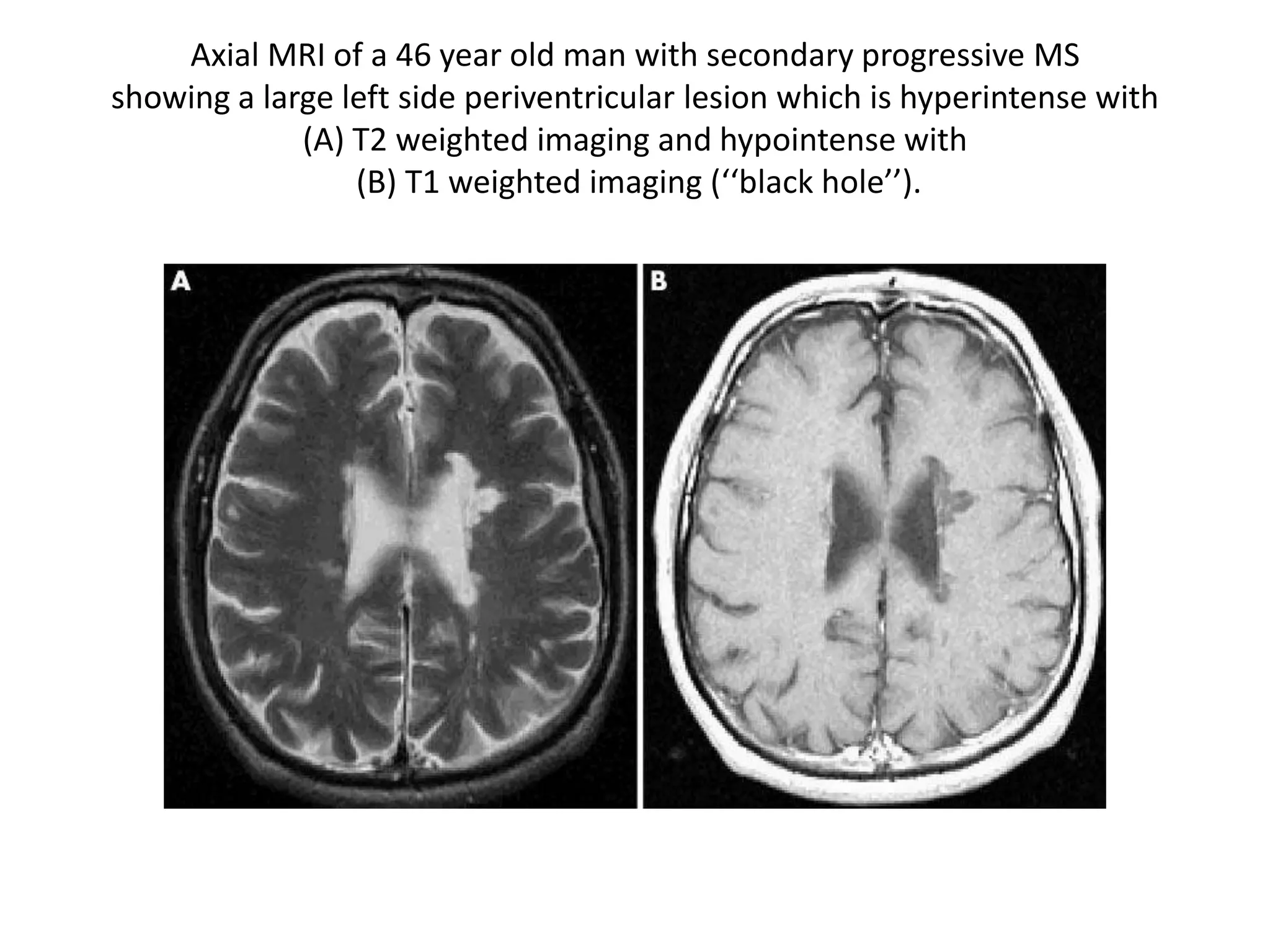 Radiology of MULTIPLE SCLEROSIS | PPTX