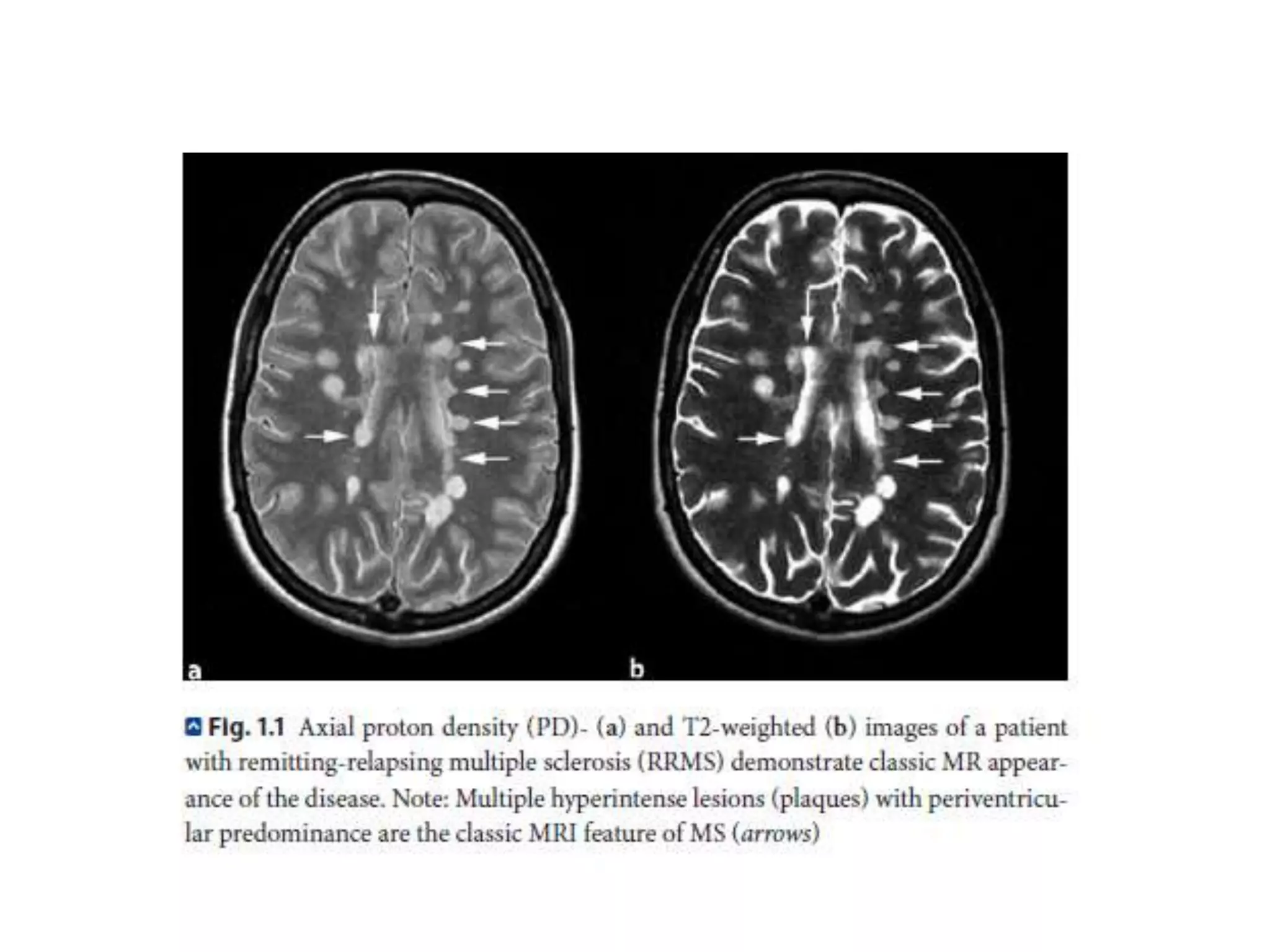 Radiology of MULTIPLE SCLEROSIS | PPTX