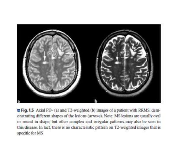 Radiology of MULTIPLE SCLEROSIS | PPTX