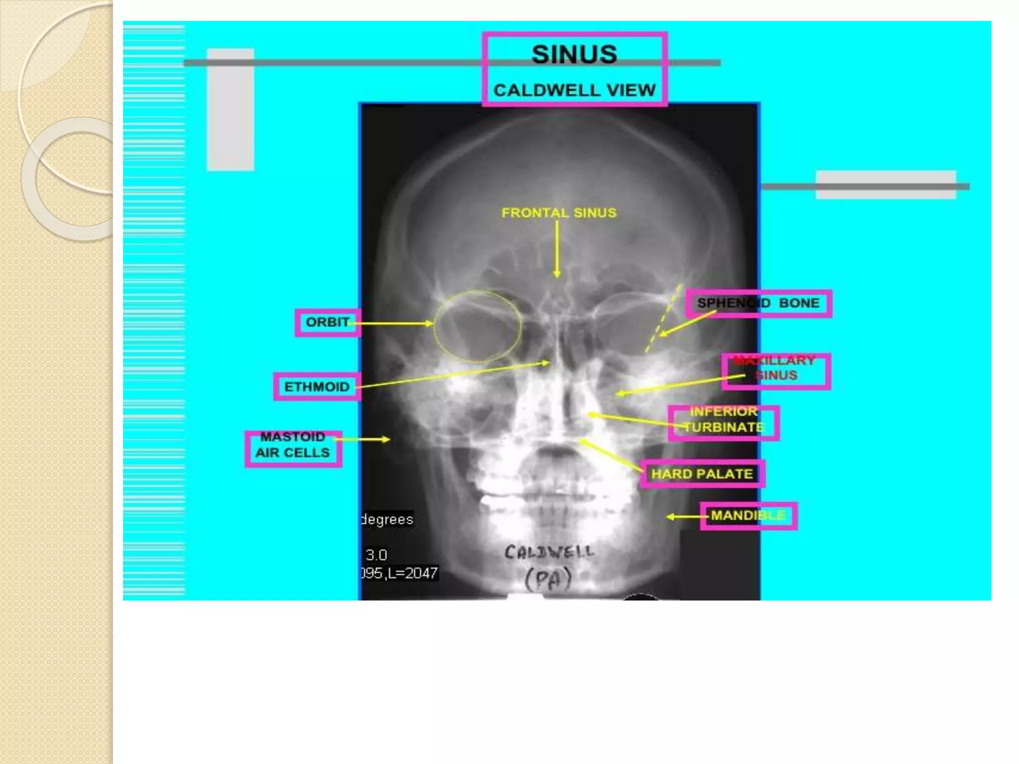 Radiology of nose and paranasal sinuses | PPTX