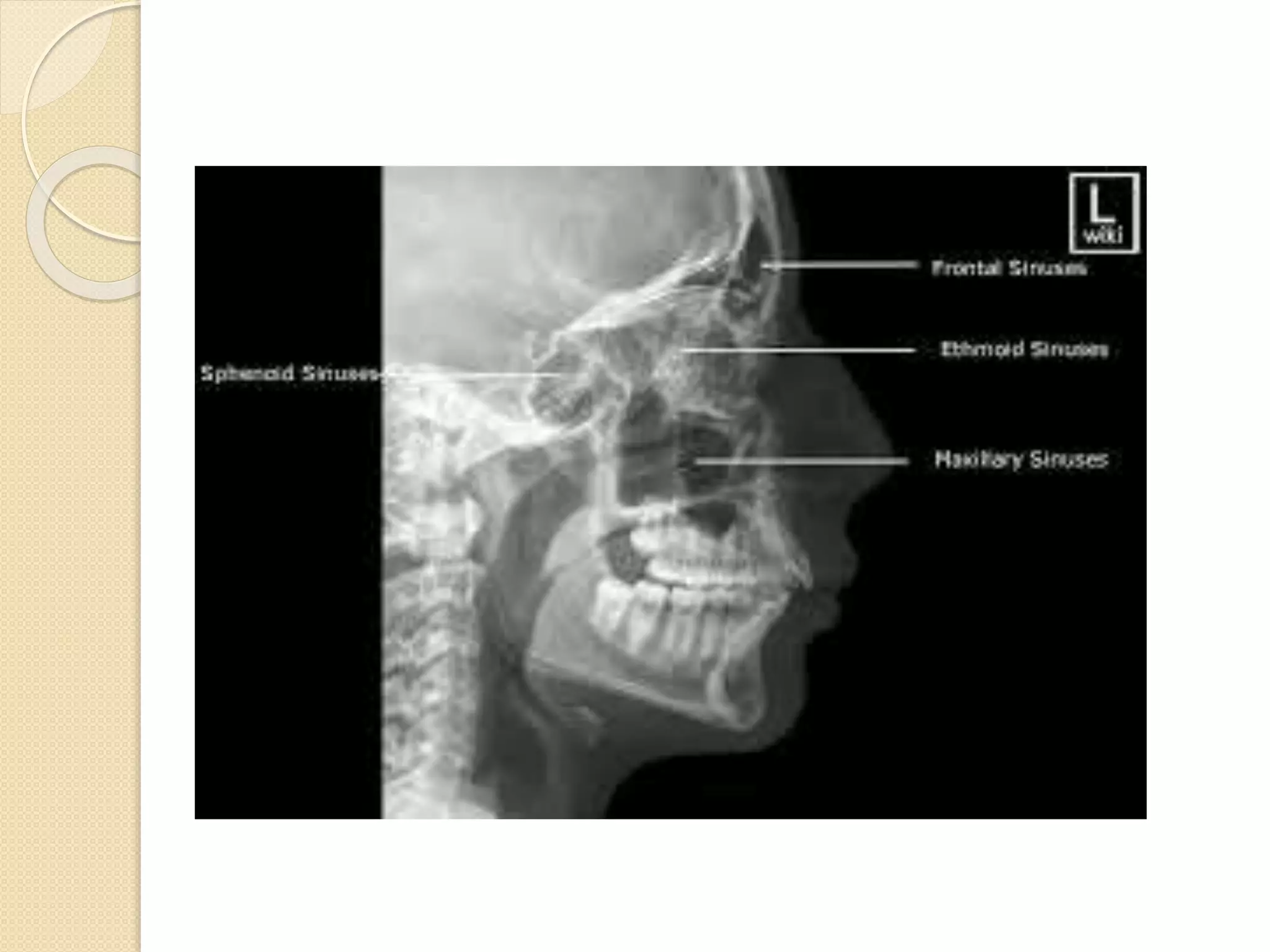 Radiology of nose and paranasal sinuses | PPTX