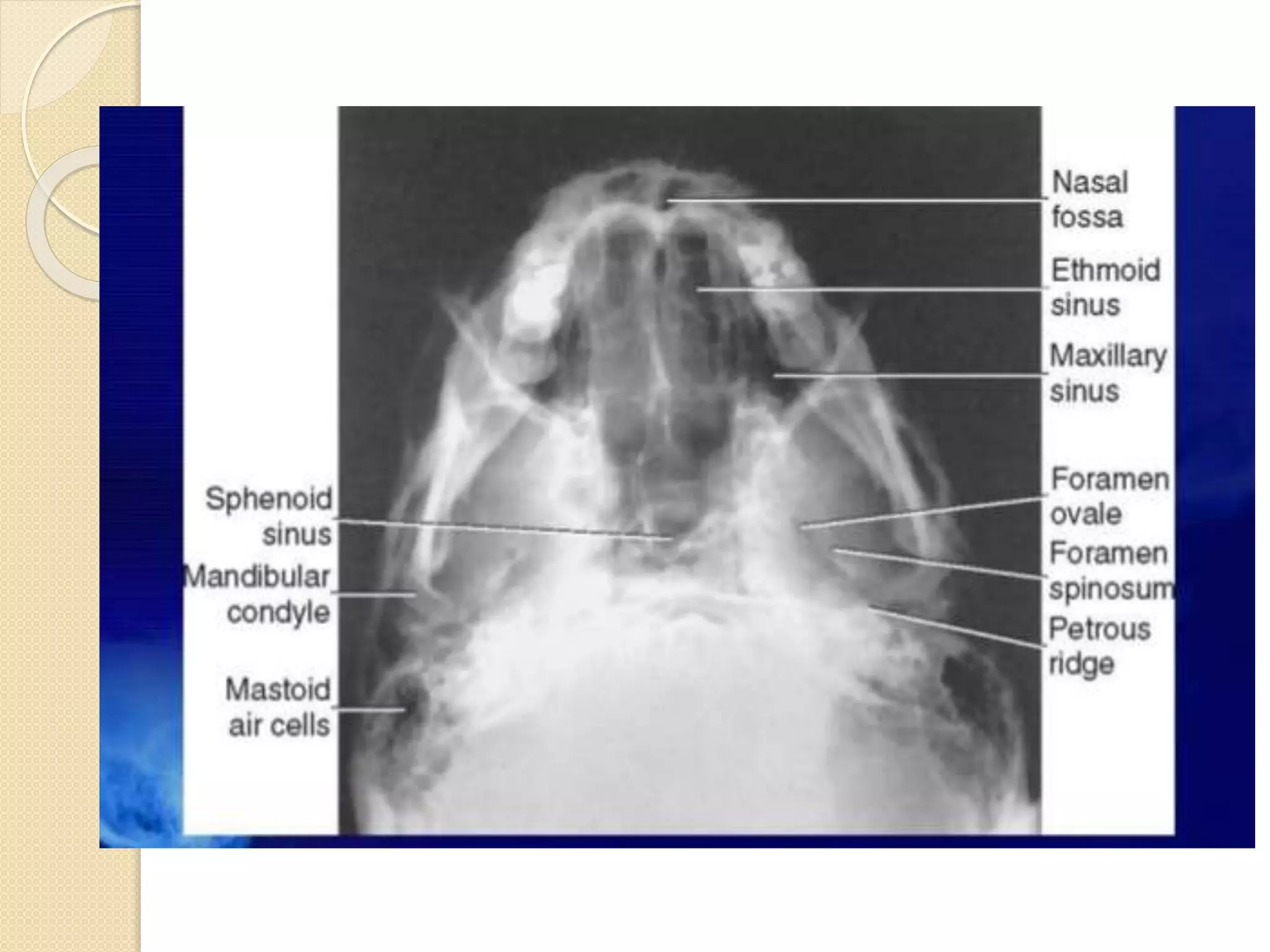 Radiology of nose and paranasal sinuses | PPTX