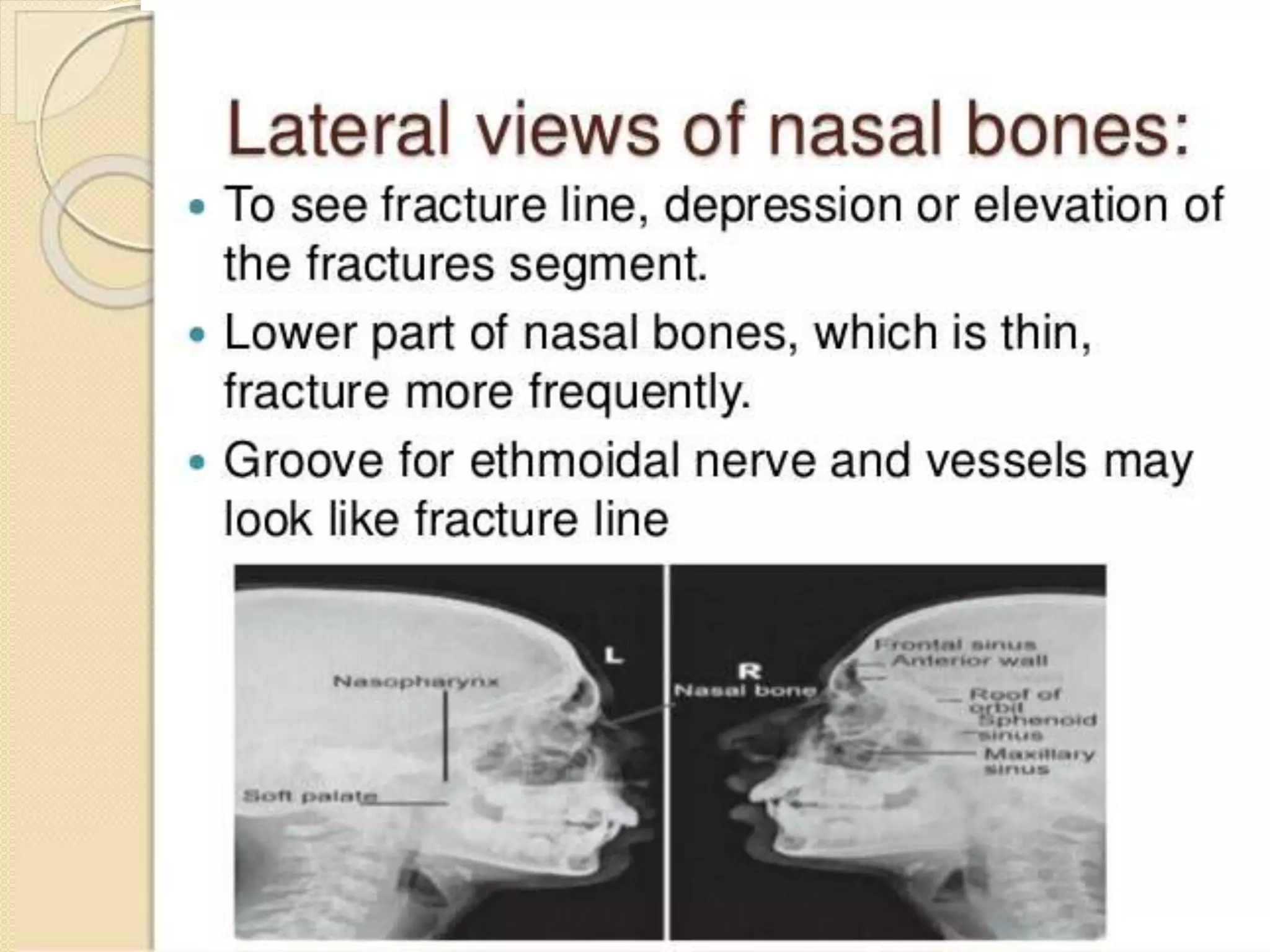 Radiology of nose and paranasal sinuses | PPTX
