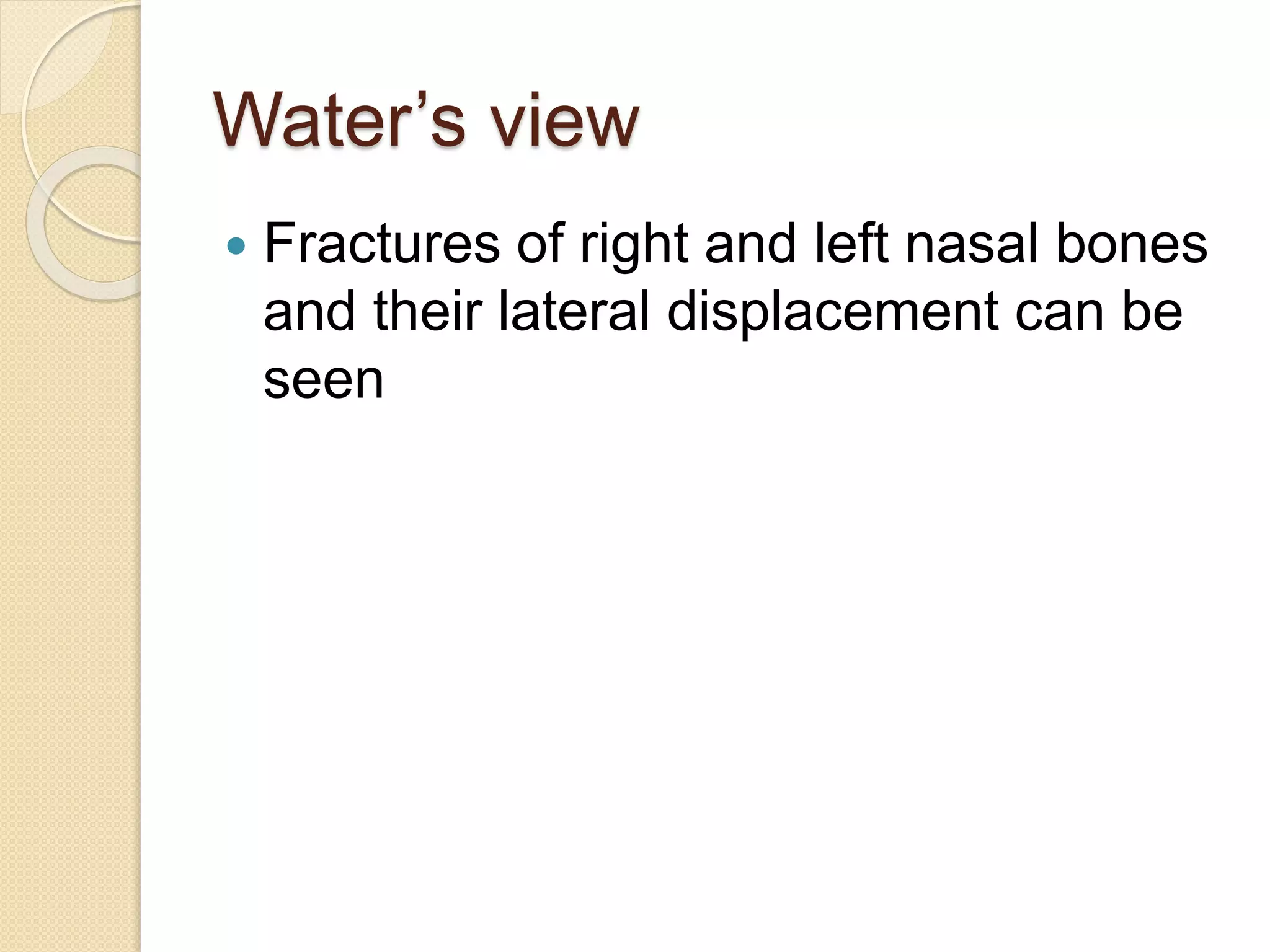 Radiology of nose and paranasal sinuses | PPTX