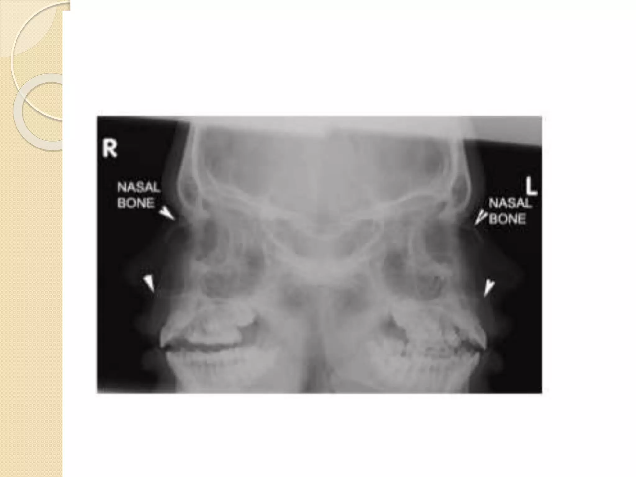Radiology of nose and paranasal sinuses | PPTX