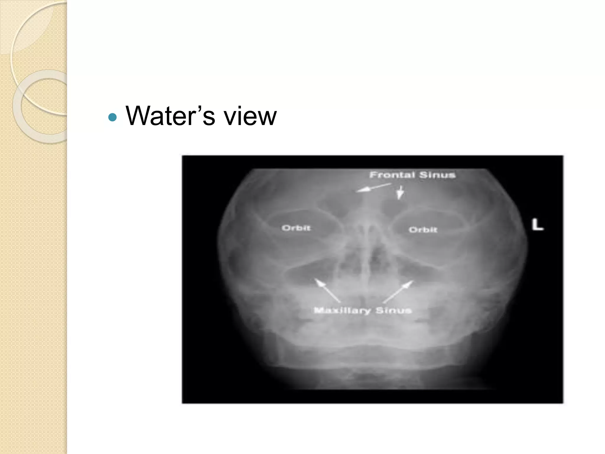 Radiology of nose and paranasal sinuses | PPTX