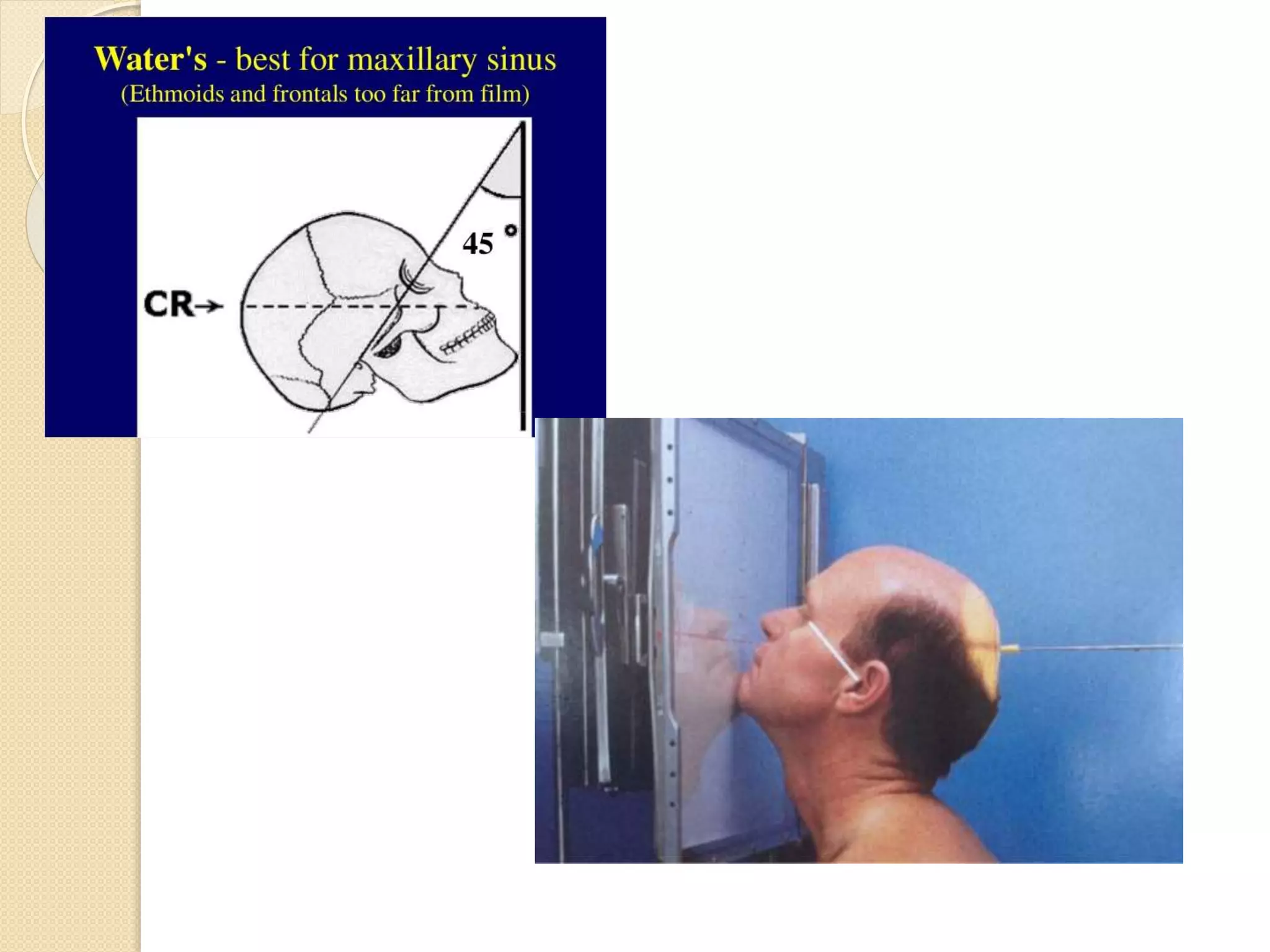 Radiology of nose and paranasal sinuses | PPTX