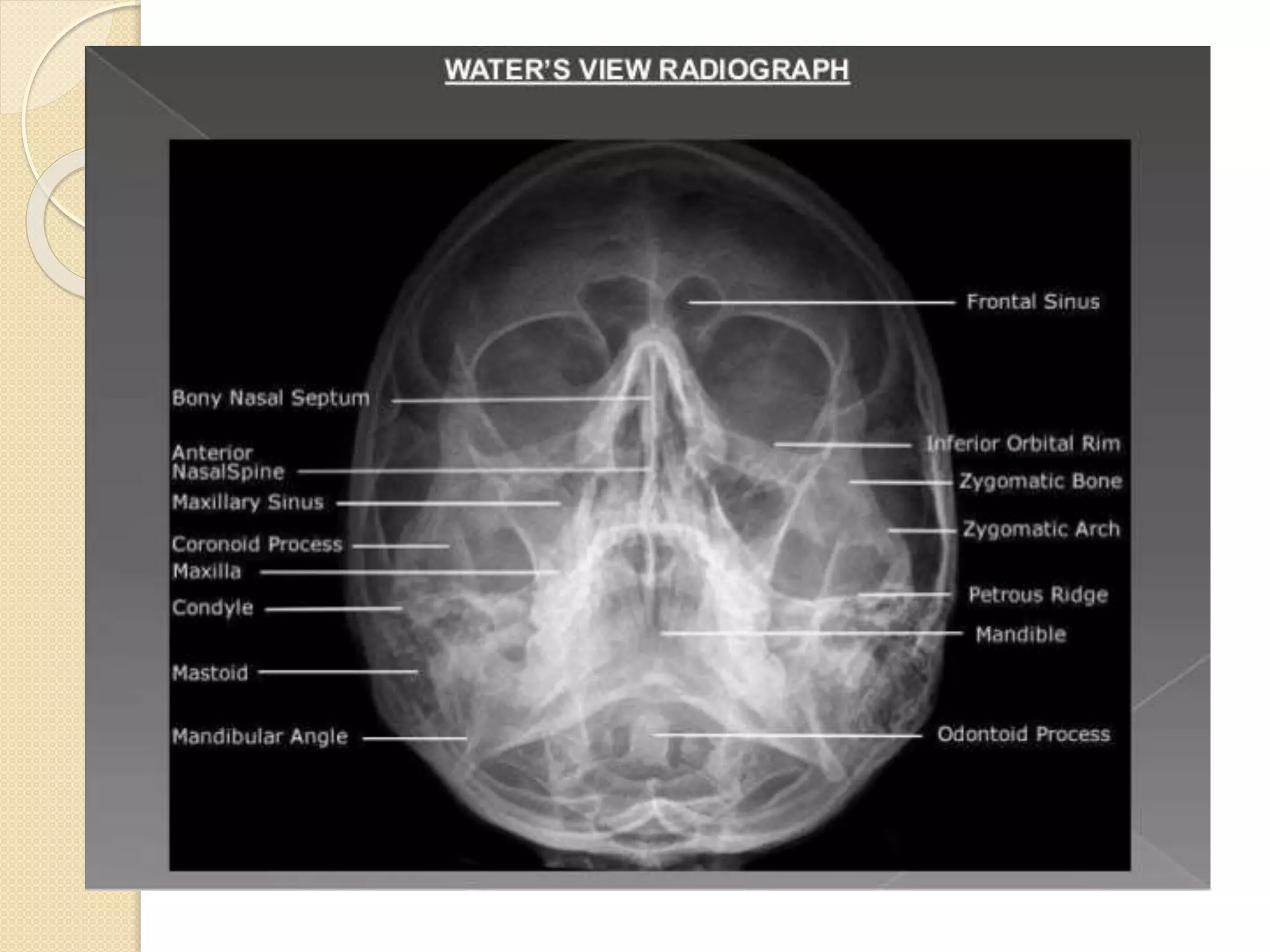 Radiology of nose and paranasal sinuses | PPTX