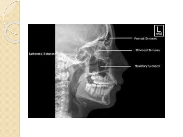 Radiology of nose and paranasal sinuses | PPTX