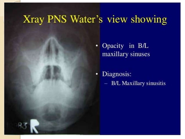 Radiology of nose and paranasal sinuses | PPTX